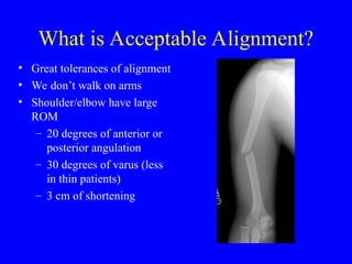 Humerus_fractures_management_and_outcomes.ppt