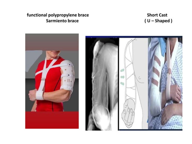 Humerus Shaft Fractur-OSCE.pptx