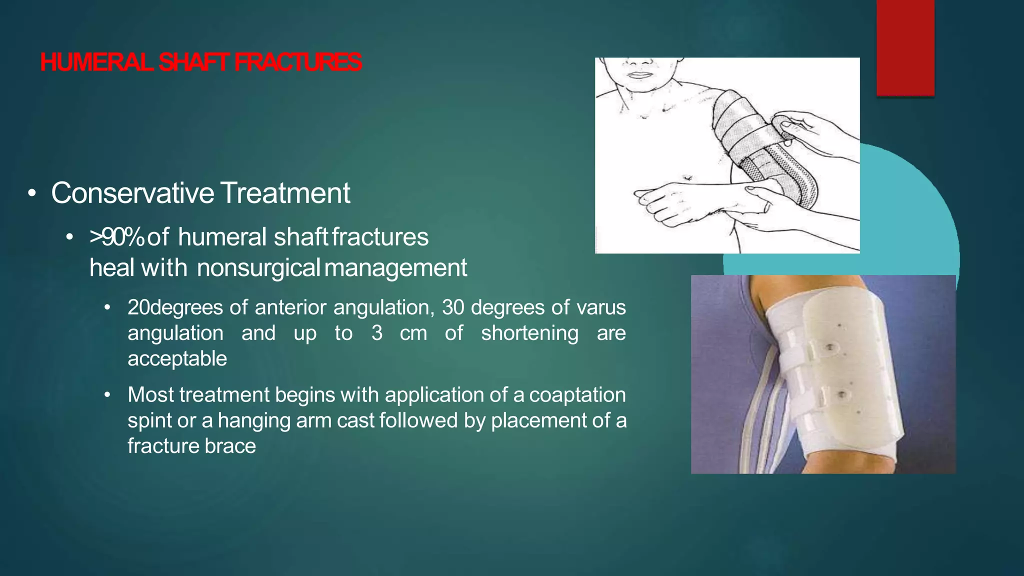 Humerus shaft fracture and elbow dislocation by dr ashutosh | PPT