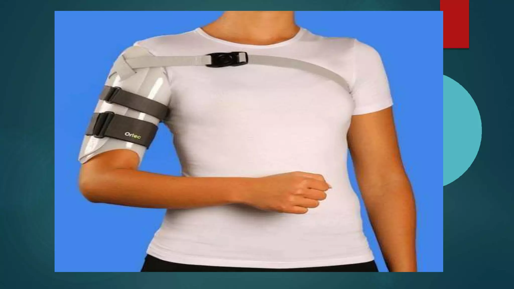 Humerus shaft fracture and elbow dislocation by dr ashutosh | PPT