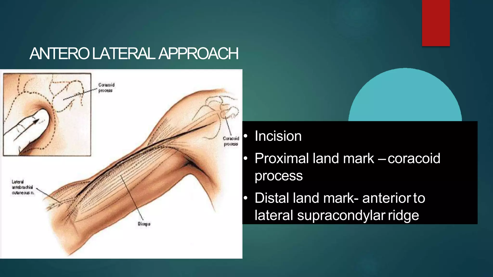 Humerus shaft fracture and elbow dislocation by dr ashutosh | PPT