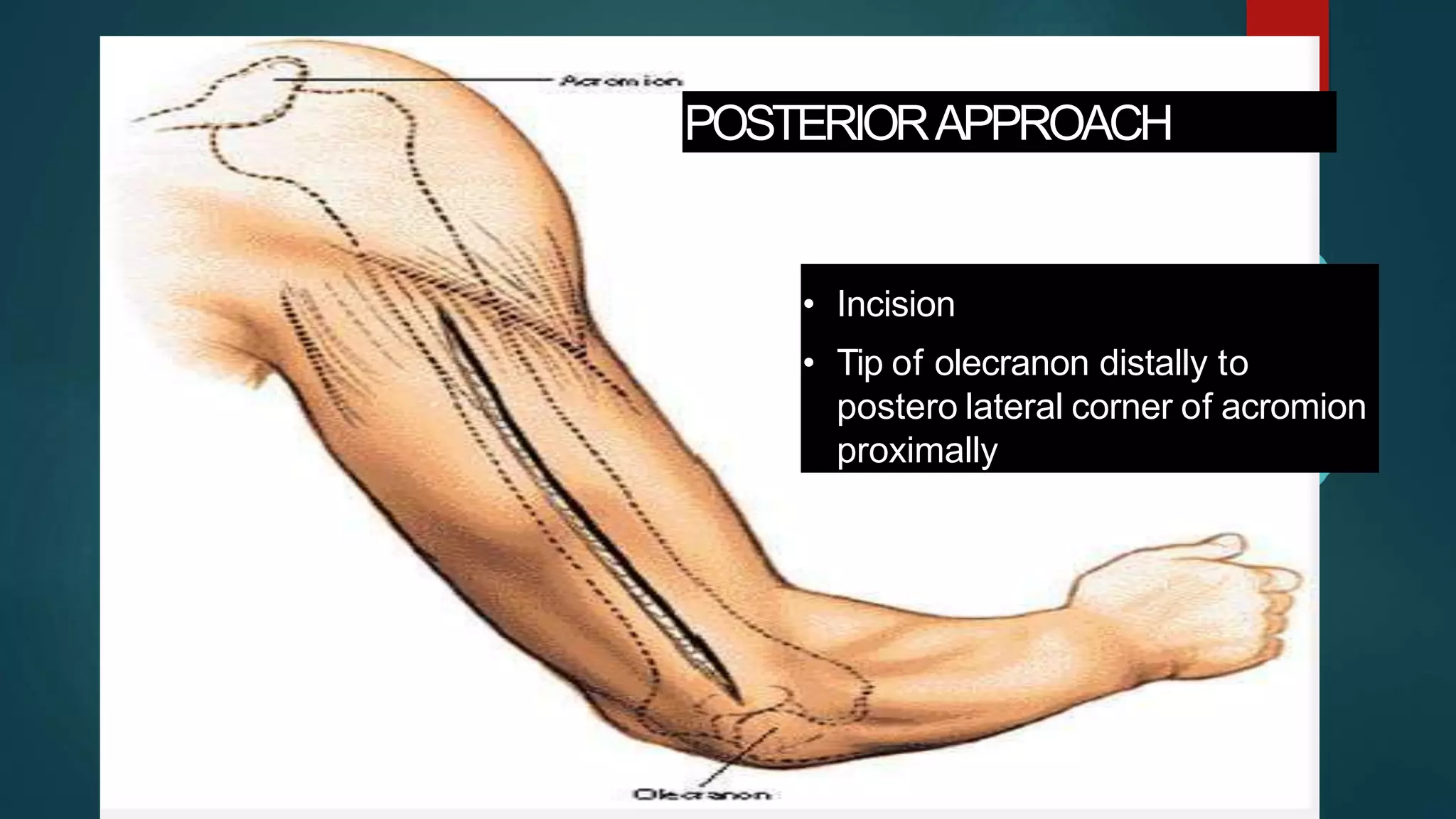 Humerus shaft fracture and elbow dislocation by dr ashutosh | PPT