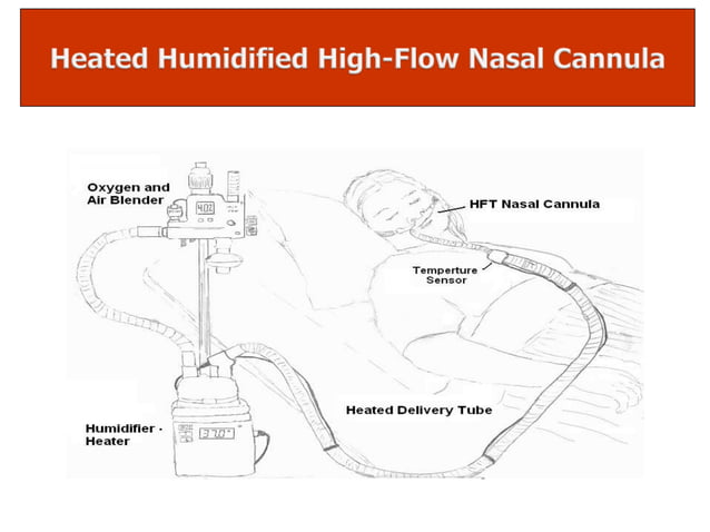 Humidfied nasal cannula | PPT