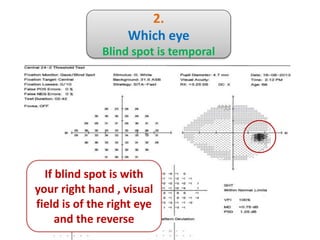 Humphery perimetry interpretation (part1) | PPT
