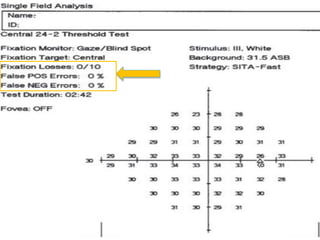 Humphery perimetry interpretation (part1) | PPTX