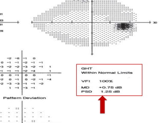 Humphery perimetry interpretation (part1) | PPTX