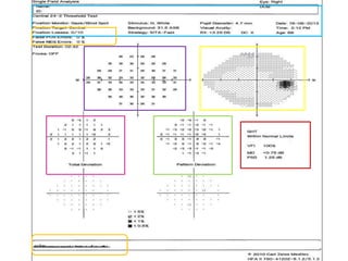 Humphery perimetry interpretation (part1) | PPTX