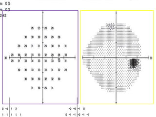 Humphery perimetry interpretation (part1) | PPT