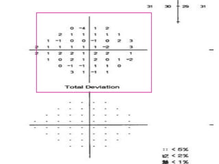 Humphery perimetry interpretation (part1) | PPT