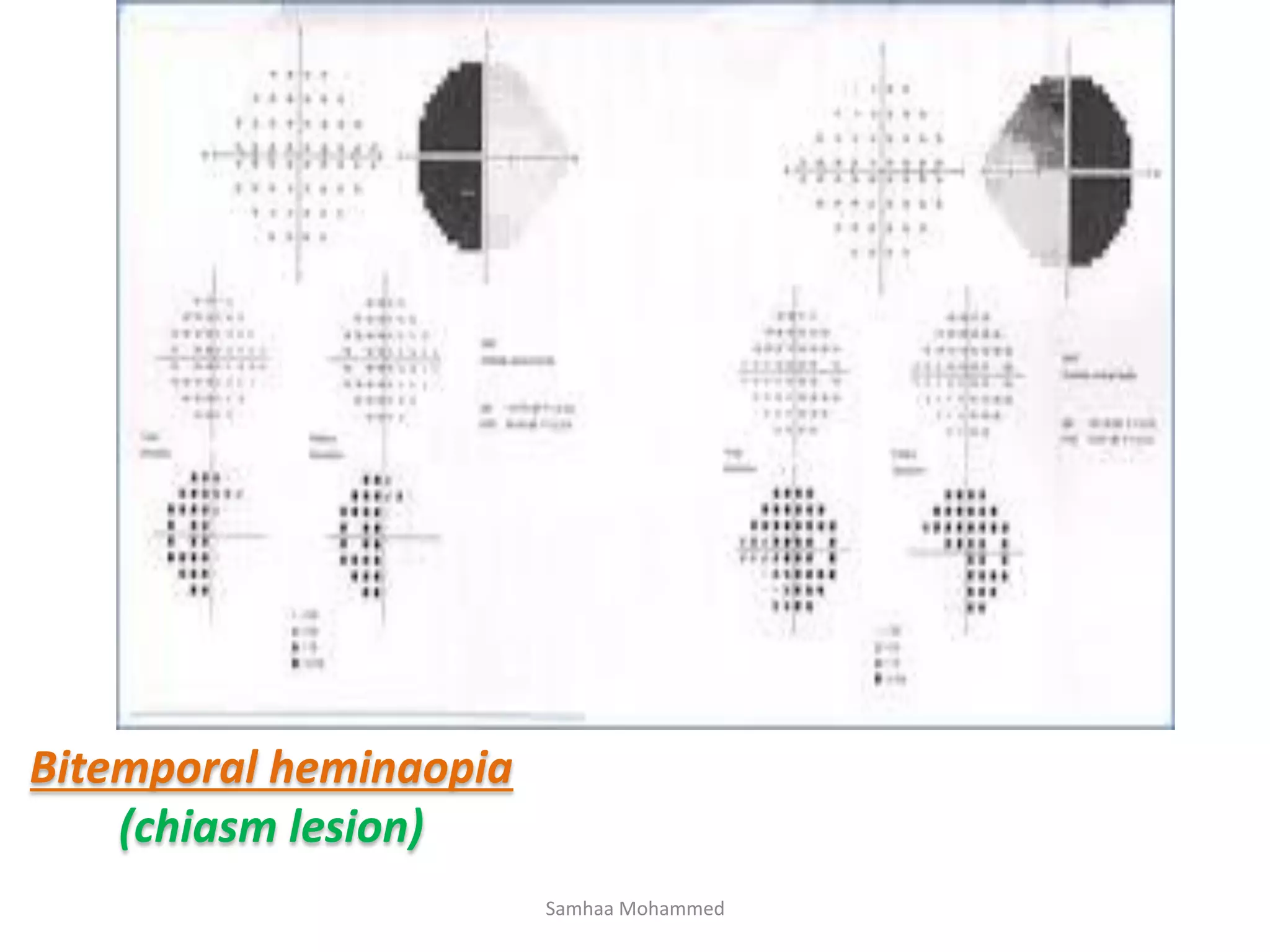 Humphery perimetry interpretation (part2) | PDF