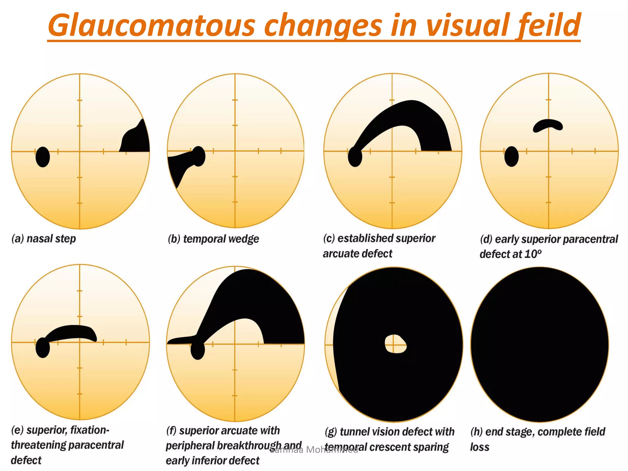 Humphery perimetry interpretation (part2) | PDF