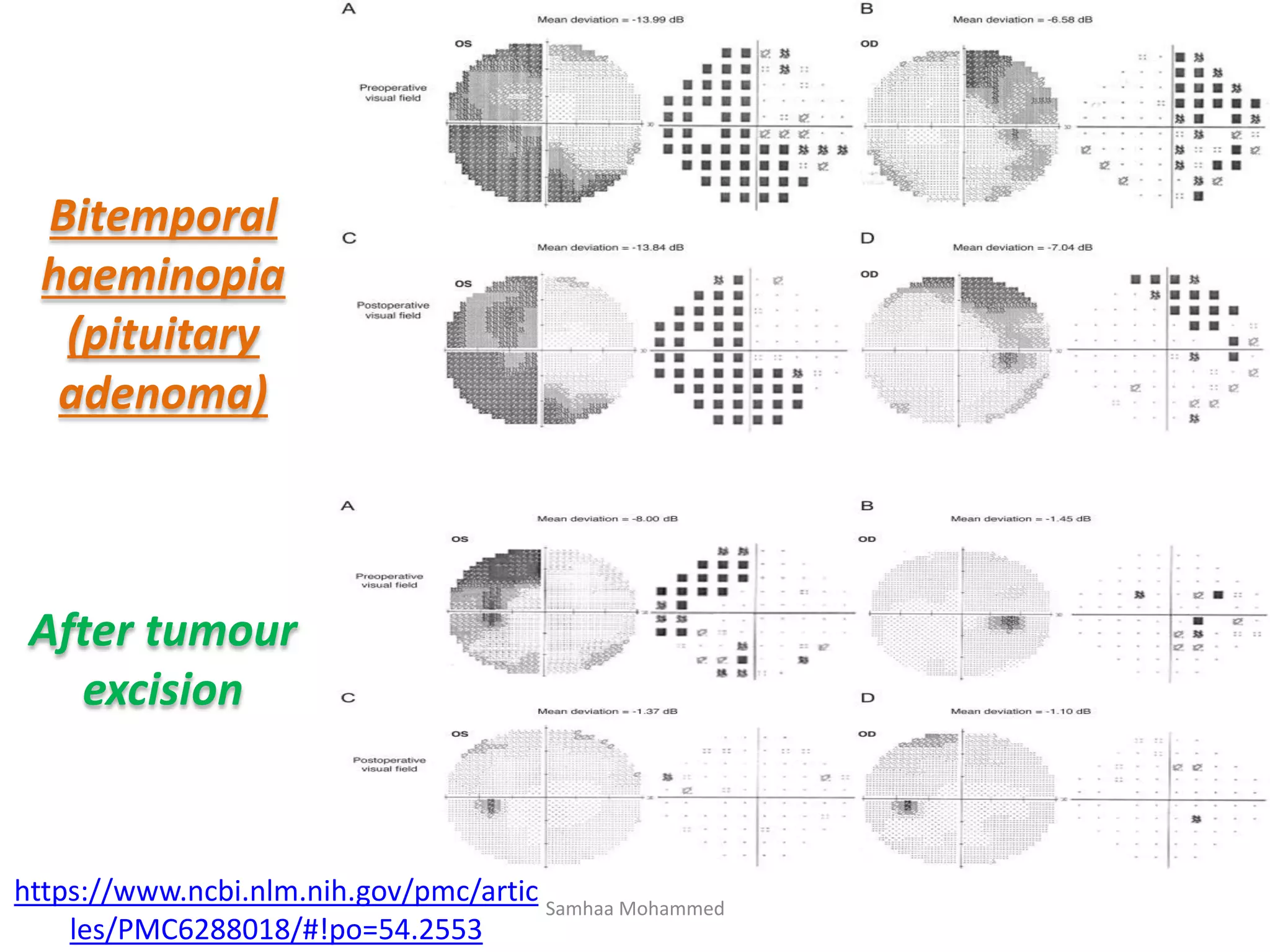 Humphery perimetry interpretation (part2) | PDF
