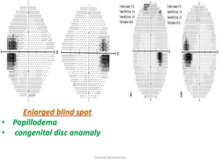 Humphery perimetry interpretation (part2) | PDF