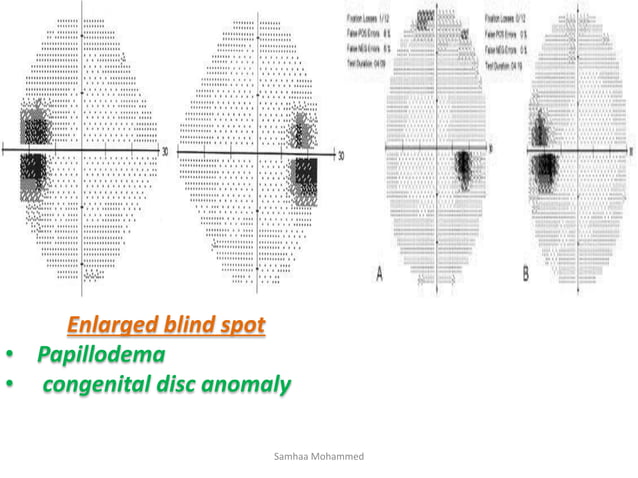 Humphery perimetry interpretation (part2) | PDF