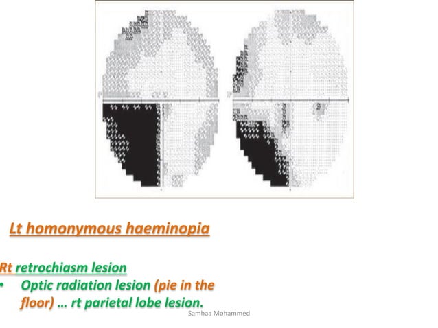 Humphery perimetry interpretation (part2) | PDF