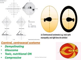 Humphery perimetry interpretation (part2) | PDF