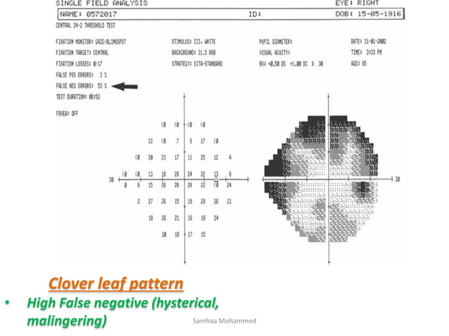 Humphery perimetry interpretation (part2) | PDF