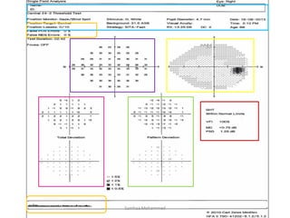 Humphery perimetry interpretation (part2) | PDF