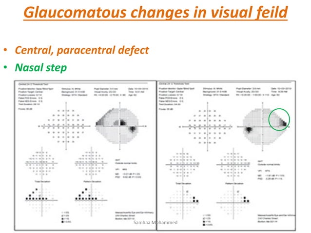 Humphery perimetry interpretation (part2) | PDF