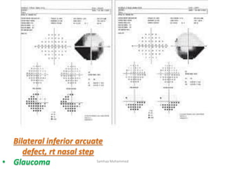 Humphery perimetry interpretation (part2) | PDF