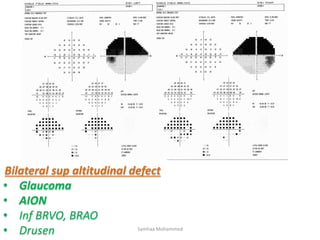 Humphery perimetry interpretation (part2) | PDF