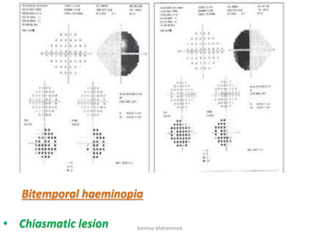 Humphery perimetry interpretation (part2) | PDF