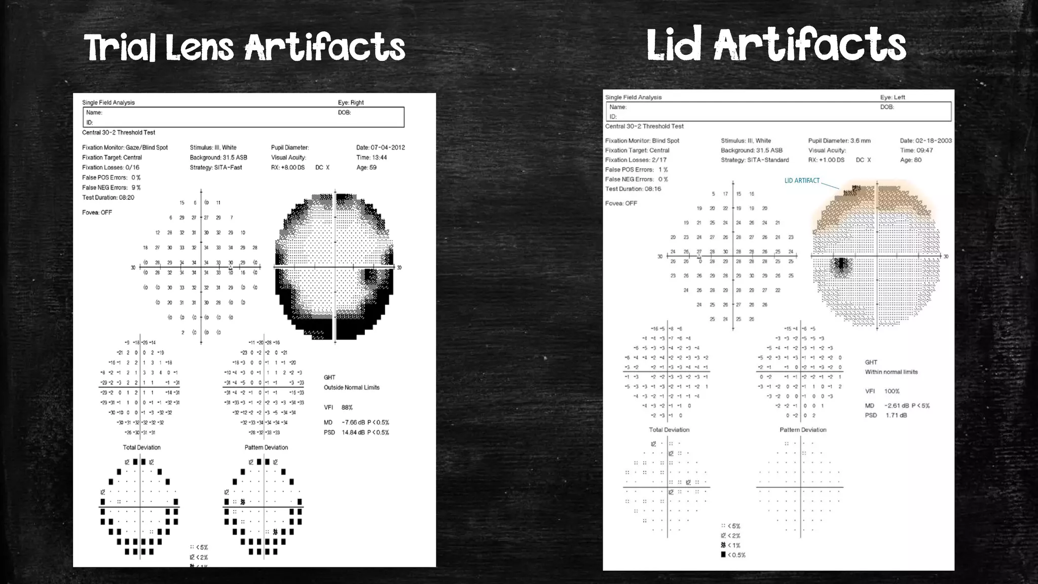Visual Field | Humphrey Perimetry | PDF