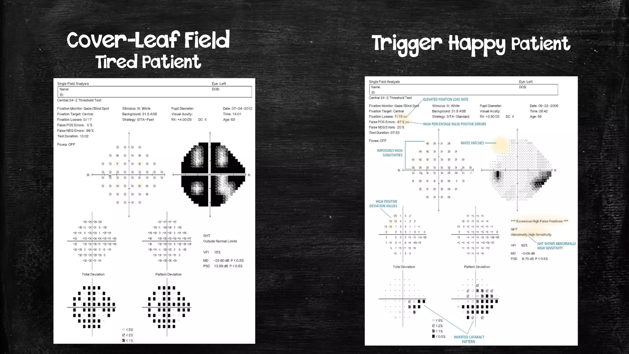 Visual Field | Humphrey Perimetry | PDF