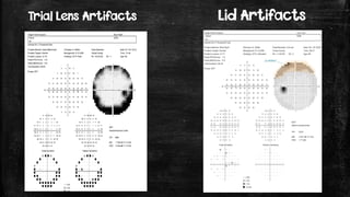 Visual Field | Humphrey Perimetry | PDF
