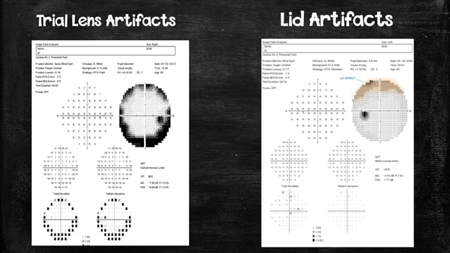 Visual Field | Humphrey Perimetry | PDF | Eye and Vision Conditions | Diseases and Conditions