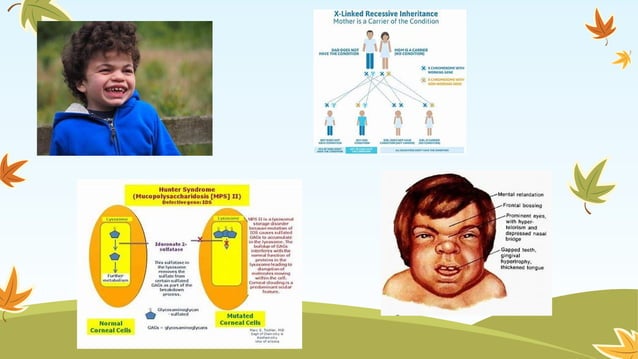 Hunter’s Syndrome Shifa Pediatrics .pptx