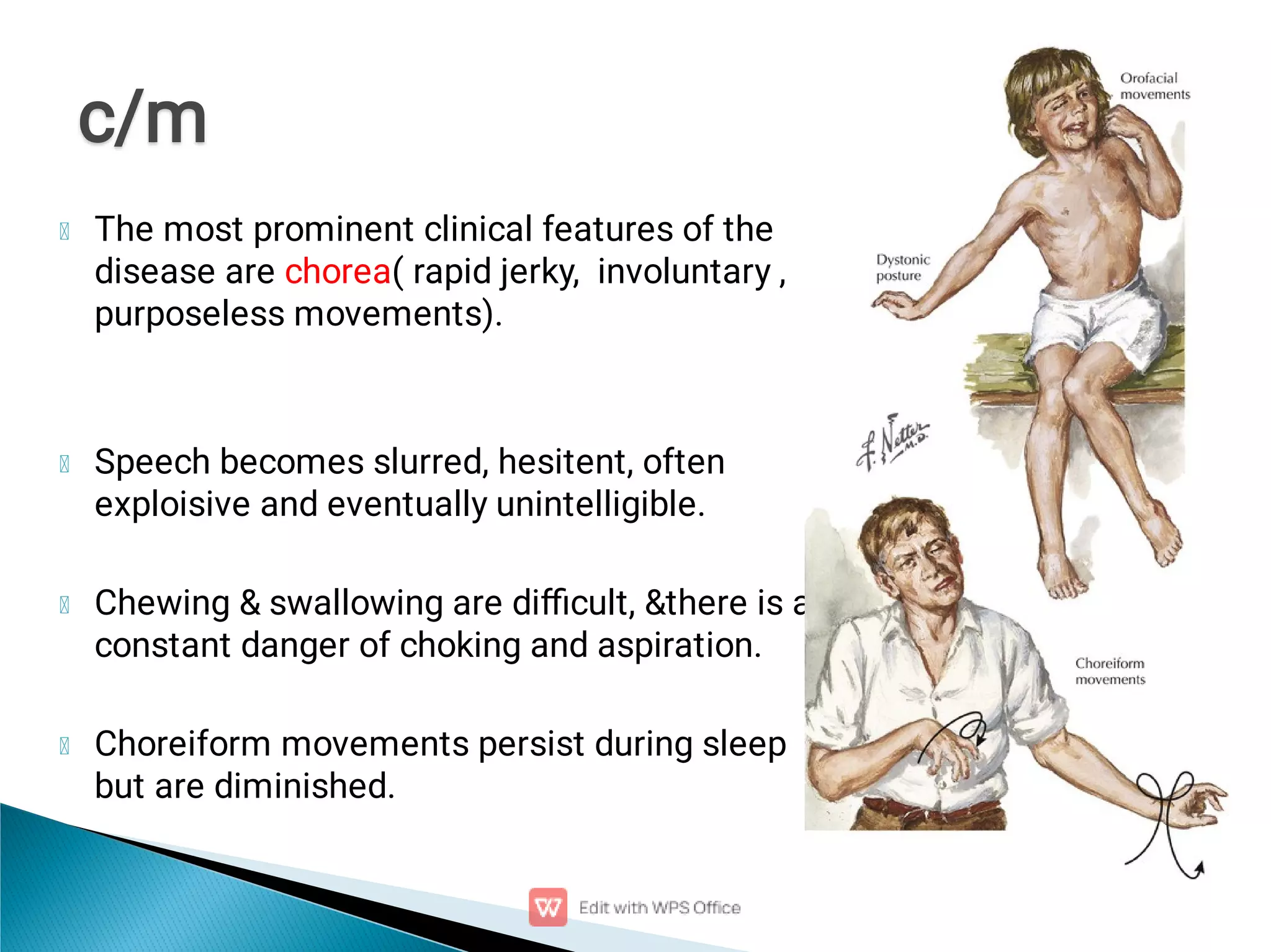 huntington disease presentation by archana.pdf