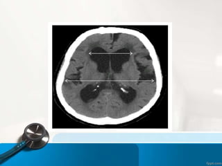 Huntingtons chorea- Genetics | PPTX