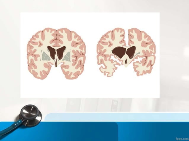 Huntingtons chorea- Genetics | PPTX | Brain and Nervous System ...