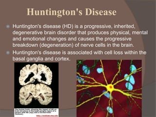 Huntington's Disease .ppt