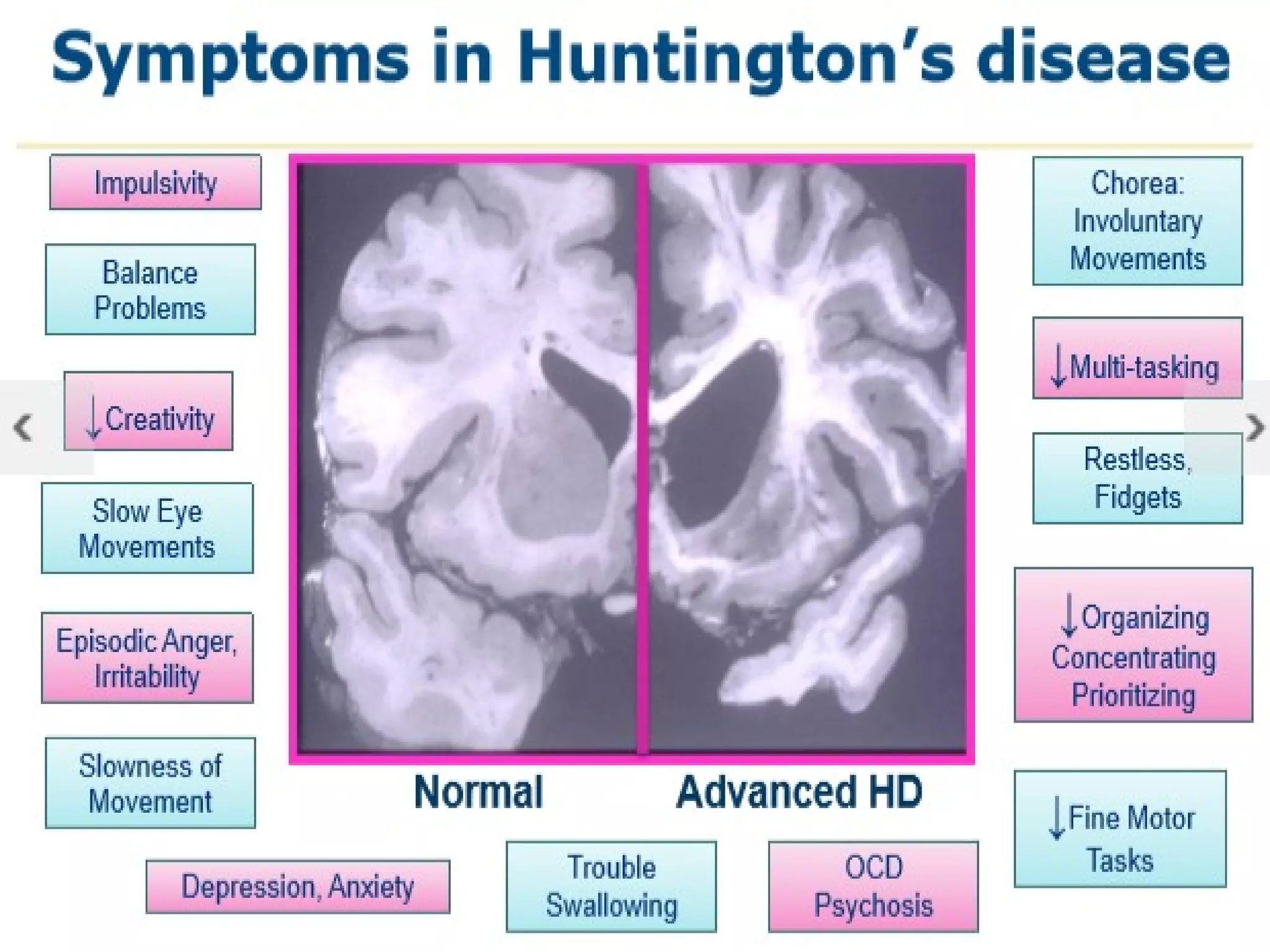 Huntington’s disease | PPT | Brain and Nervous System Disorders ...