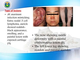 Mycobacterium marinum | PPTX