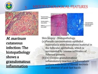 Mycobacterium marinum | PPTX