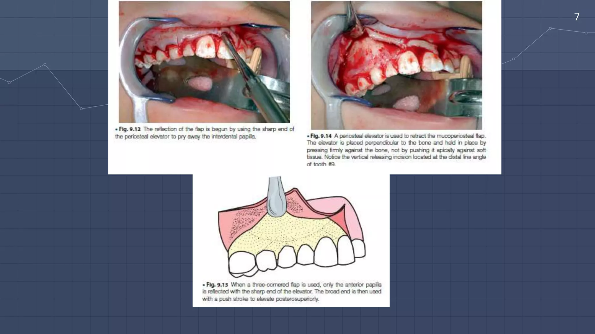 HUPP PRINCIPLES OF FLAP DESIGN, DEVELOPMENT AND MANAGEMENT - MUHAMMAD ...