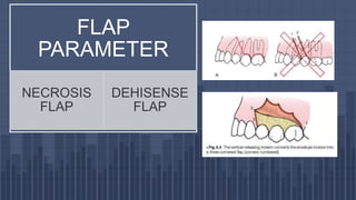 HUPP PRINCIPLES OF FLAP DESIGN, DEVELOPMENT AND MANAGEMENT - MUHAMMAD LUTTFAN.pptx