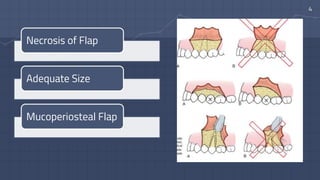 HUPP PRINCIPLES OF FLAP DESIGN, DEVELOPMENT AND MANAGEMENT - MUHAMMAD ...