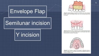 HUPP PRINCIPLES OF FLAP DESIGN, DEVELOPMENT AND MANAGEMENT - MUHAMMAD ...