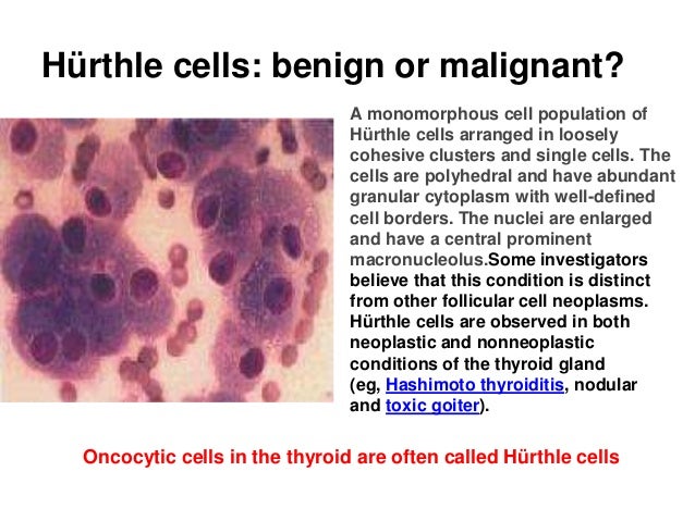 Hurthel's cell ca of the thyroid gland