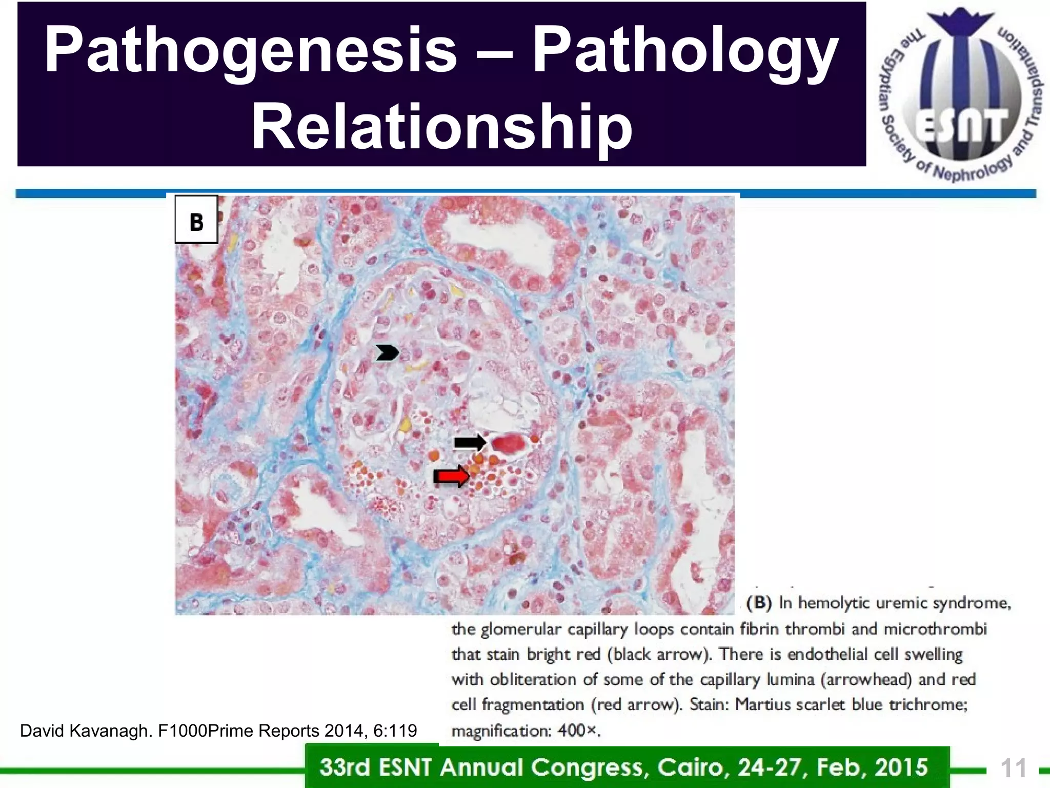 Hemolytic Uremic Syndrome Induced AKI (From Pathogenesis to Bedside ...