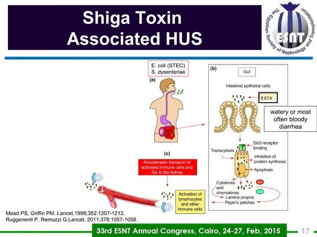 Hemolytic Uremic Syndrome Induced AKI (From Pathogenesis to Bedside ...