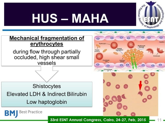 Hemolytic Uremic Syndrome Induced AKI (From Pathogenesis to Bedside ...