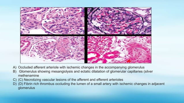HEMOLYTIC UREMIC SYNDROME IN CHILDREN 2022 BY DR VIJITHA | PPTX