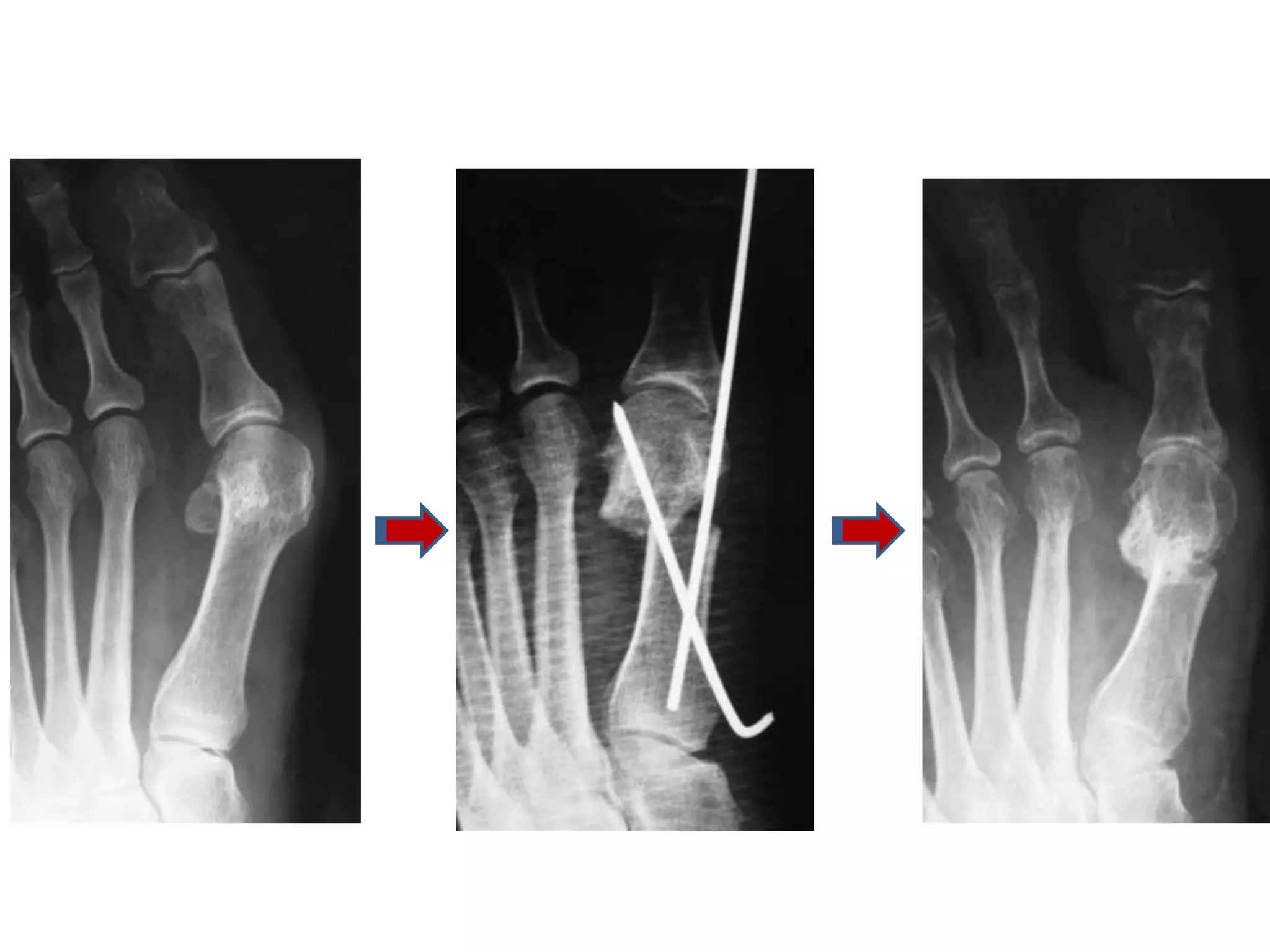 Hv distal osteotomi edit_hHALLUKS VALGUS - DİSTAL OSTEOTOMİLER | PPTX