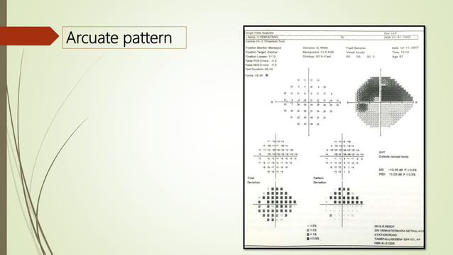 Perimetry & Humprey visual field assay (HVFA) | PPTX | Eye and Vision Conditions | Diseases and ...