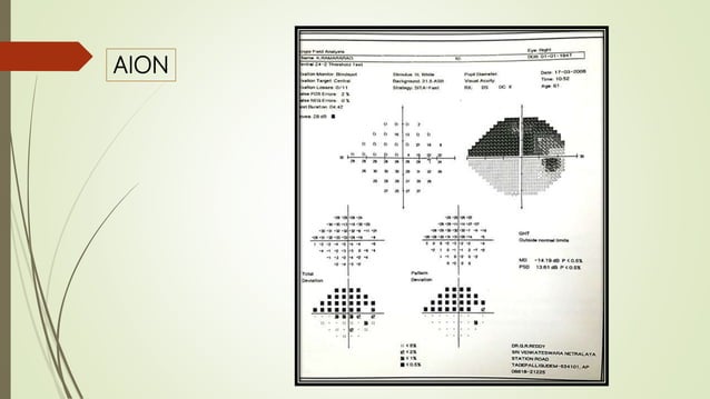 Perimetry & Humprey visual field assay (HVFA) | PPTX | Eye and Vision Conditions | Diseases and ...